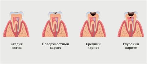 Кариес: причины возникновения, лечение | Взубе.ком