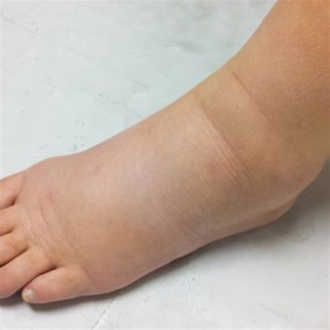 Lymphödem: Behandlung & Diagnose direkt vom Online-Hautarzt | doctorderma