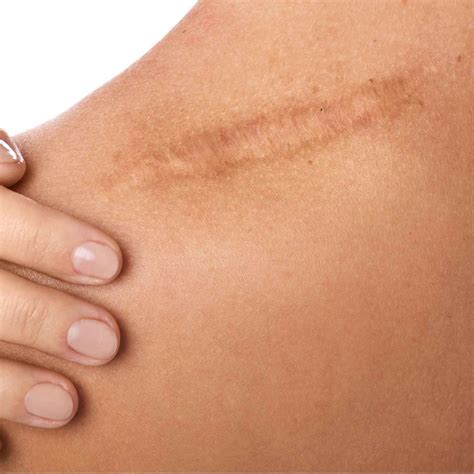 Top 98+ Pictures Pictures Of Knee Replacement Scars Sharp