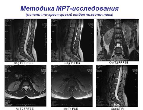 МРТ поясничного отдела позвоночника — подробное описание с адресами клиник