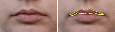 Can I Change My Lip Shape With Volume Enhancement?