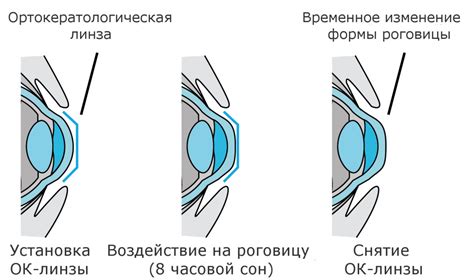 Ночные линзы