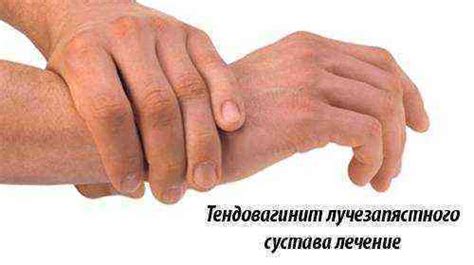Тендовагинит лучезапястного сустава: что такое, как лечить заболевание ...