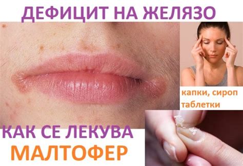 Малтофер: оптимална форма за приемане на желязо. За лечение и ...