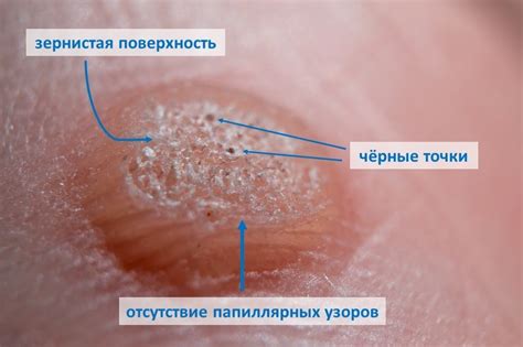 Подошвенные бородавки (шипицы) : причины появления, способы лечения ...
