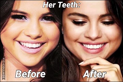 The 411 Dirt: Did You Know Selena Gomez Has VENEERS?! *2019*