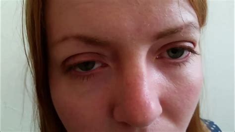 Sign of Hypnosis - Eye Flutter - YouTube