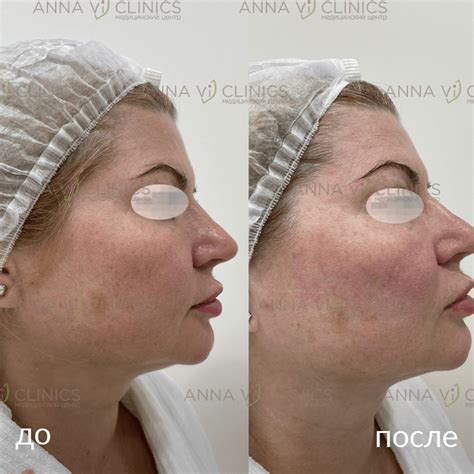 SMAS лифтинг - viclinics.kz