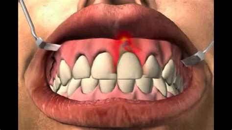 Fistel - YouTube