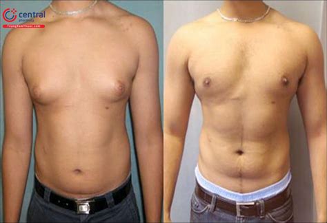 Đánh giá bệnh vú to nam giới là sinh lý hay bệnh lý