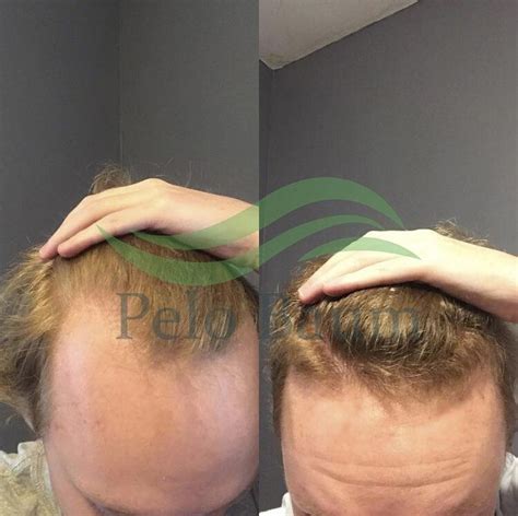 Pelo Baum - инновационная пептидная линия для роста волос | DoctorHair.ru