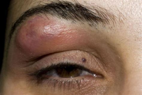 Pimple on Eyebrows, Causes and How to Get Rid of Pimple Around Eyebrows ...