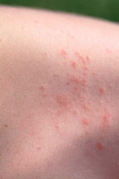Heat rash or prickly heat | Raising Children Network