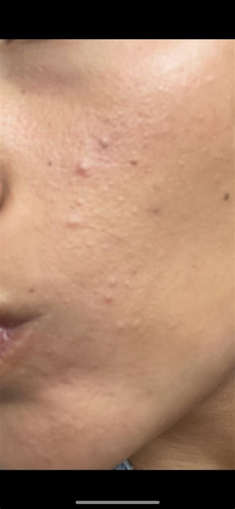 One Week Results from PanOxyl 10% : r/SkincareAddicts