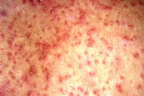14 Causes of a Pimple-Like Rash