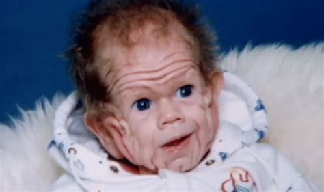 Das einzigartigste Baby mit der ungewöhnlichen Haut