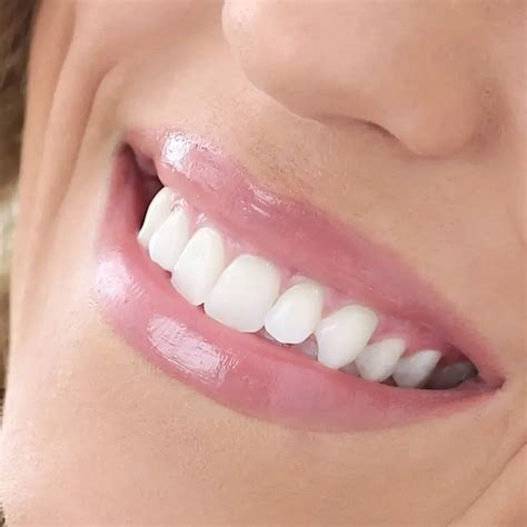 Looking for Safe Teeth Whitening in El Dorado AR? Visit Dr. Paul Burns ...
