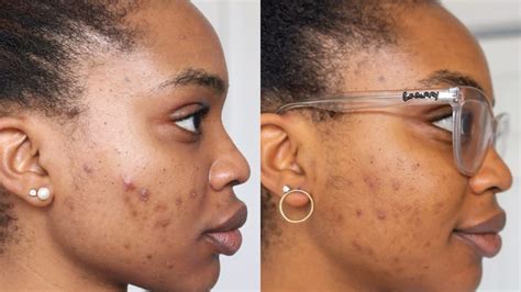 The Esthetician Recommended Products That Cleared Up My Acne | Ijeoma ...
