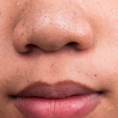 Blackheads - The Cosmetic Clinic