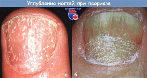 Углубления ногтей (foveolae psoriaticae) при псориазе
