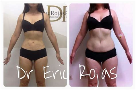Abdomen Slim Láser - Dr. Eric Rojas - Dermatología Laser Center
