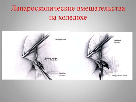 Острый холецистит - презентация онлайн