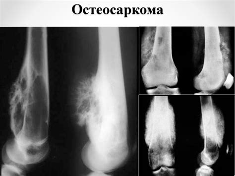 Остеосаркома. Эпидемиология остеосаркомы - презентация онлайн