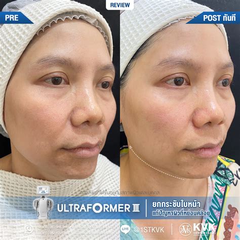 Ultraformer III คืออะไร, 46% OFF
