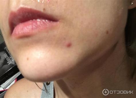 Отзыв о Подсушивающий крем от прыщей Uriage Hyseac Pate SOS | Работает ...
