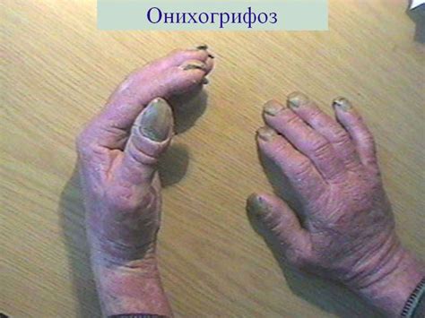 Псориаз, КПЛ - презентация онлайн