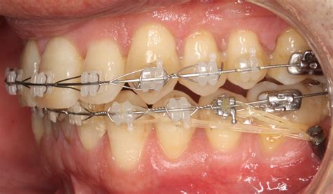 Microimplantes Bucal-Shelf