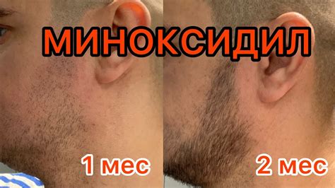 Миноксидил.Результат миноксидила для бороды. Применение миноксидила ...