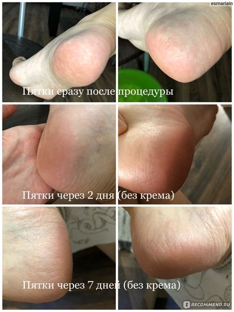 Гель для ног Чудо пятки для педикюра - «Действительно ли «чудесное ...