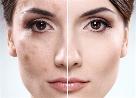 Мази от пигментных пятен на лице из аптеки и косметические средства ...
