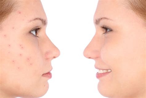 What do you know about acne?