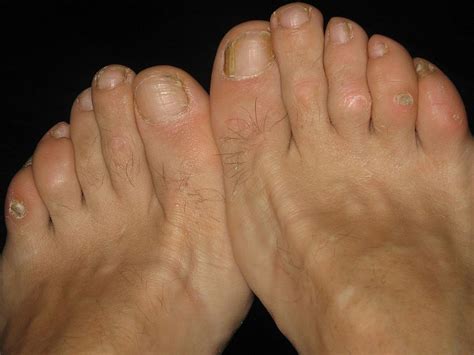 Callous vs. Callus - What's the difference? | Ask Difference