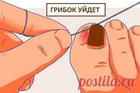 Избавиться от микоза ногтей можно быстро и просто, если знаешь этот су ...