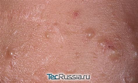 Комедоны открытые и закрытые (белые и черные) на коже лица – лечение и ...