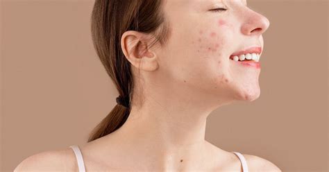 What are Blemishes | Ana K Cosmetics | Clean Beauty by AnaK