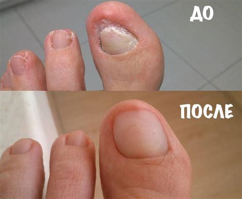 Что делать при ушибе ногтя, если ноготь слезает?