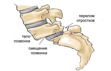 Смещение позвонков поясничного отдела: как лечить - Русская ...