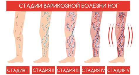 КОМПРЕССИОННОЕ БЕЛЬЕ ПРИ ВАРИКОЗЕ — Подруженька