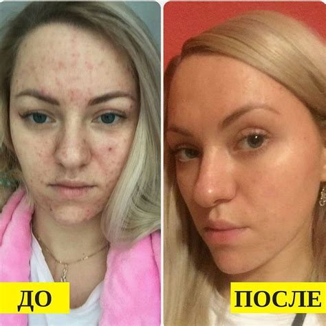 Профессиональная чистка лица у косметолога и в домашних условиях ...