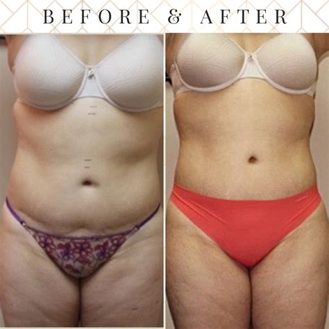 Ultra Slim | Beautique Medical Spa