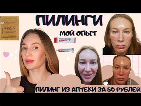 Все про пилинги. Мой опыт с фото. Аптечный пилинг из Бадяги с перекисью ...