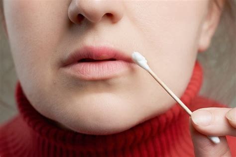 Как лечить герпес: основные принципы терапии | MedAboutMe