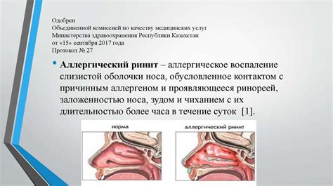 Аллергический ринит - online presentation