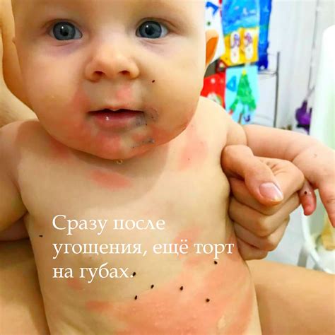 АЛЛЕРГИЯ? СЕРА — ЛУЧШИЙ ПОМОЩНИК! — Княгинюшка