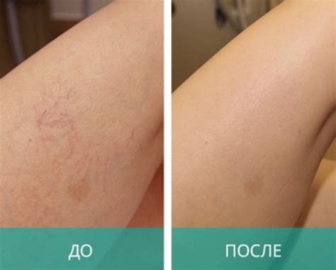 Варикоз. Какие способы профилактики и лечения варикоза? | ORTO.Salon