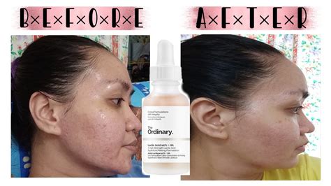 THE ORDINARY LACTIC ACID 10% + HA | With Before & After - YouTube